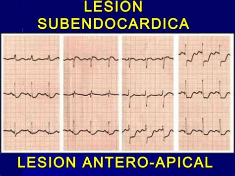 Isquemialesión Y Necrosis