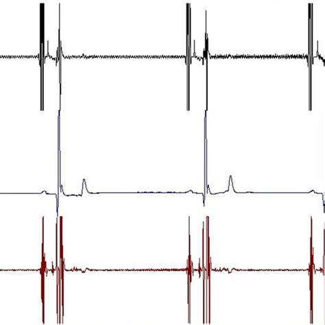 His Bundle Electrograms Top Trace Is A His Bundle Electrogram Recorded