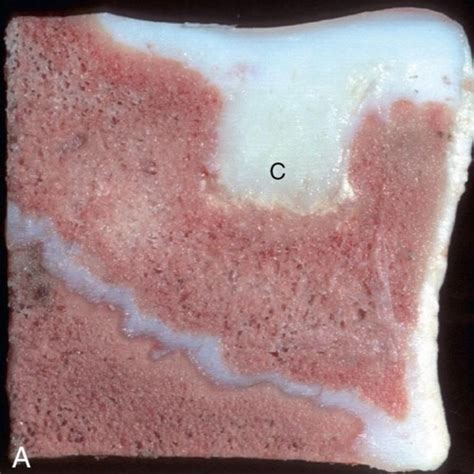 Bone Pathology Flashcards Quizlet