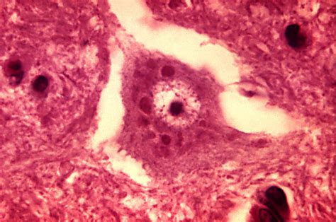 Rabies Virus And Infection Microbiology Medbullets Step 1
