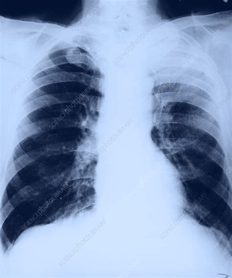 Lung Cancer Pre Op 1 3 Stock Image C0252918 Science Photo Library