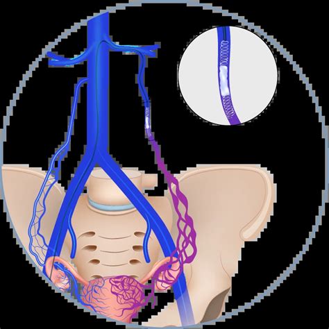 Pelvic Venous Disorder Colorado Advanced Endovascular