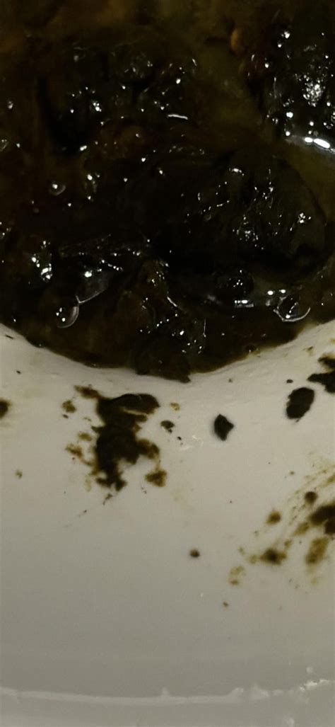 Normal Previously Had A Peptic Ulcer Upper Gi And Lower Pr Bleed