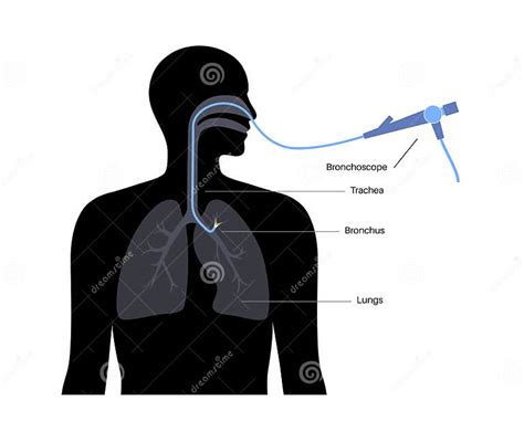 Bronchoscopy Procedure Concept Stock Vector Illustration Of
