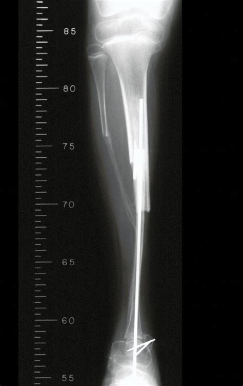 Tibialization Of The Distal Fibula Oncosurgery