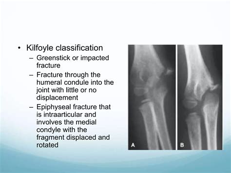 Fracture Around Elbow And Hand Ppsx