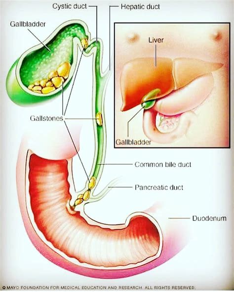 Choledocholithiasis Vs Cholelithiasis