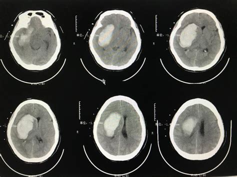 3d Slicer软件辅助神经内镜手术治疗基底节脑出血手术 脑医汇