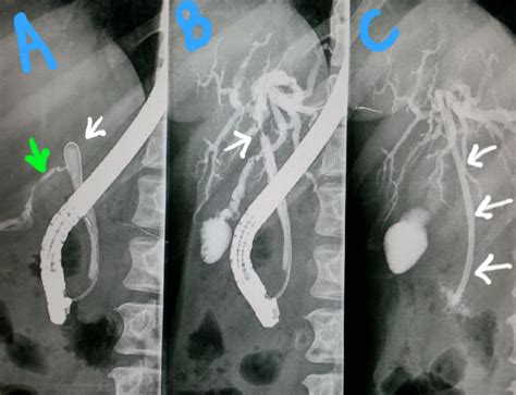 Ercp And Egd Cholangiocarcinoma And Cholangitis