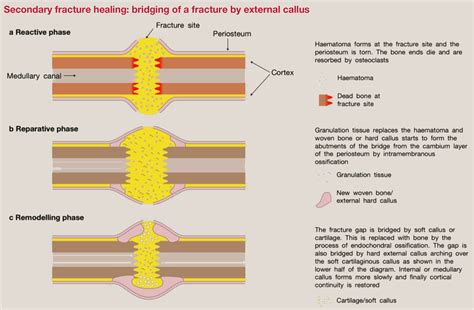Principles Of Bone Healing Surgery Oxford International Edition