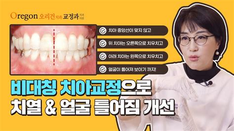 비대칭치열 치아 교정으로 얼굴 틀어짐까지 개선된 사례 소개 【feat 오리건치과 김옥경원장님】 Youtube