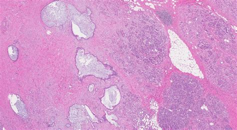 Ductal Adenocarcinoma Archives Ottawa Atlas Of Pathology