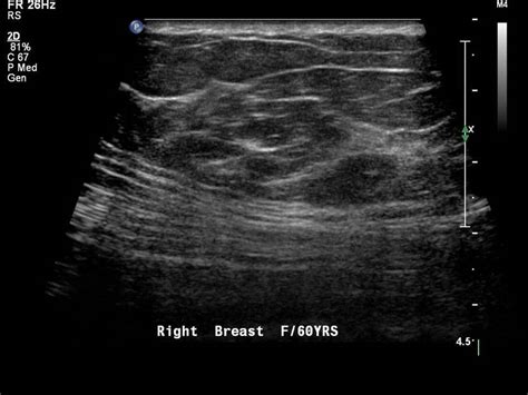 Atlas Of Breast Cancer Early Detection