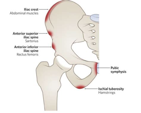 Managing Teenager Hip Pain And Hip Apophysitis Sport Doctor London