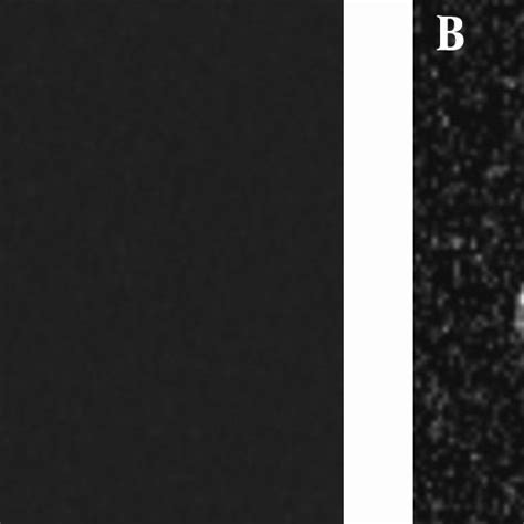 A T2 Weighted Mri Showing Hyperintense Signal Intensity Of The Lesion