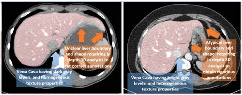 Figure 2 From Cross Modal Learning Via Adversarial Loss And Covariate Shift For Enhanced Liver