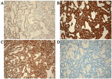 Immunohistochemical Staining Of The Thyroid‑like Low‑grade