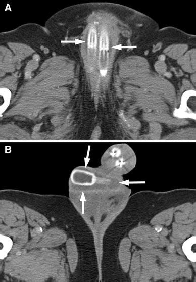 Evaluation Of Ipp Infection A Axial Ct Image Of The Base Of The Penis