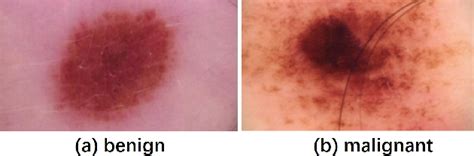 Figure 1 From Ensembling Learning Based Melanoma Classification Using