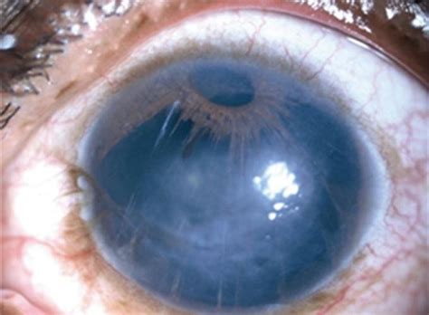 A Progressive Iris Atrophy Download Scientific Diagram
