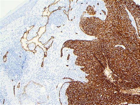 Pathology Outlines Angiosarcoma
