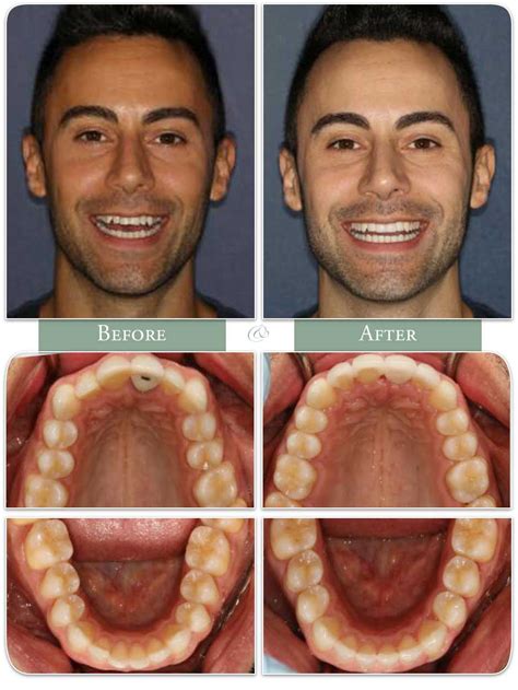 Crooked Teeth Before And After Invisalign