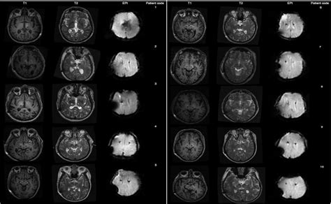 Table 1 From Diffusion And Functional Mri In Surgical Neuromodulation Semantic Scholar