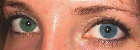 Heterochromia Treatment And Management Point Of Care