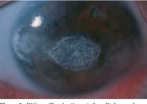 Figure 2 From Pediatric Uveitis Semantic Scholar