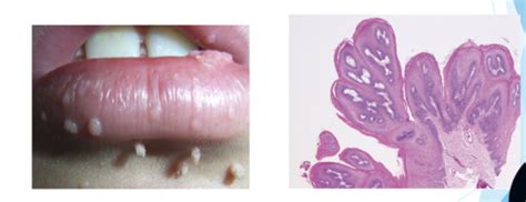 Tumour Classification Flashcards Quizlet