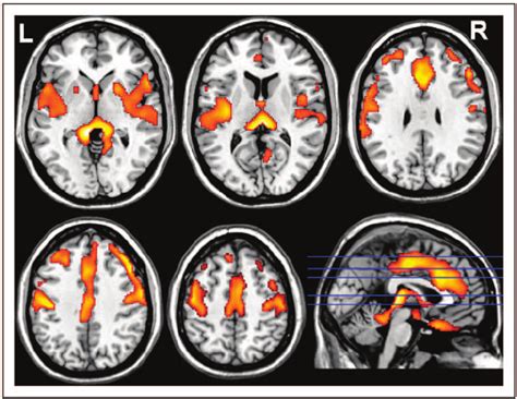 Distribution Of Regional Grey Matter Gm Loss In Patients With Benign