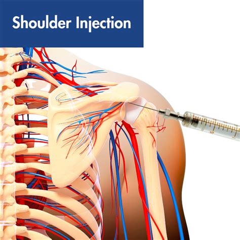 Shoulder Injections Madison Wi Shoulder Pain Treatment Wisconsin Shoulder Injections Madison Wi Shoulder Pain Treatment Wisconsin