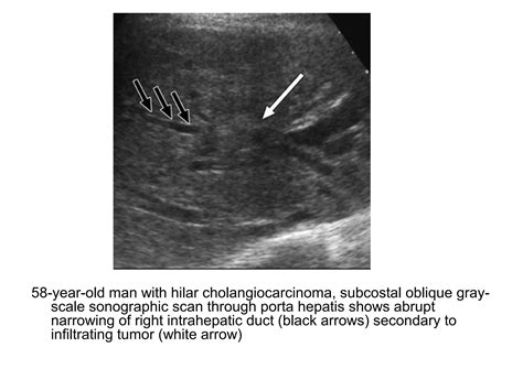 Diagnostic Imaging Of Cholangiocarcinoma Ppt