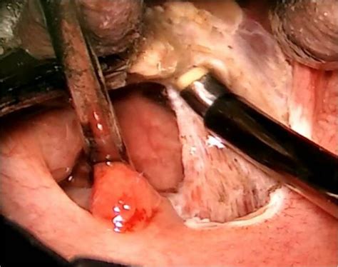 Position Of The Patient During Microscope Assisted Coblation Tonsillectomy Download