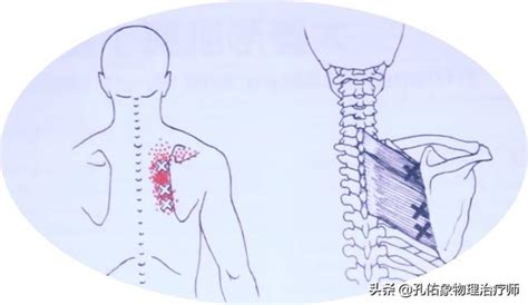 後背、肩胛骨區域疼痛，是長腫瘤嗎？為何查不出原因？詳細告訴您 每日頭條