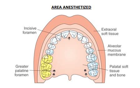 Maxillary Injections Flashcards Quizlet
