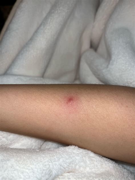 Hey Guys I Woke Up To Lump On Forearm Month Ago This Happened On Same