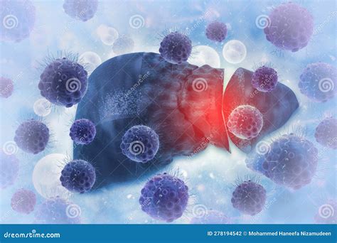 Virus Or Bacteria Infected Human Liver Liver Disease Stock