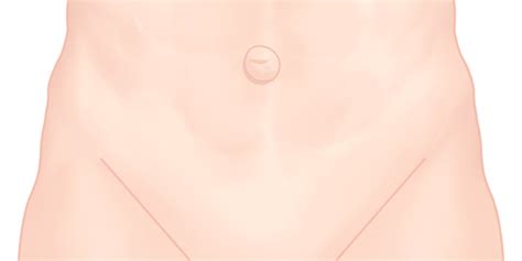 배꼽 복벽 절개 탈장 유엔비외과의원ㅣ주간응급 외과수술센터