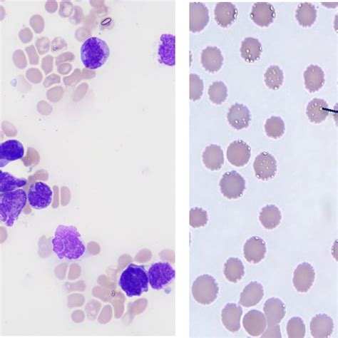 Bone Marrow Aspirate 100× Showing Abnormal Promyelocytes With Bilobed