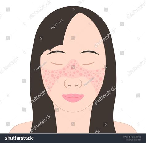 Butterfly Malar Rash Chronic Facial Pain Stock Vector Royalty Free