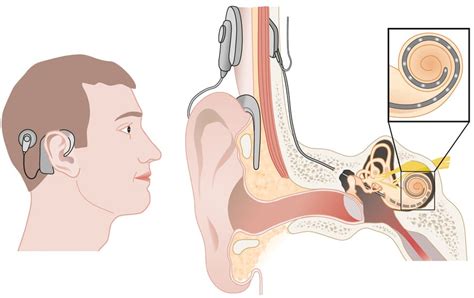 Personalised Strategies For Ci Surgery And Hearing Rehabilitation