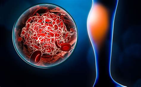 Deep Vein Thrombosis DVT How To Prevent And Manage HealthXchange Sg