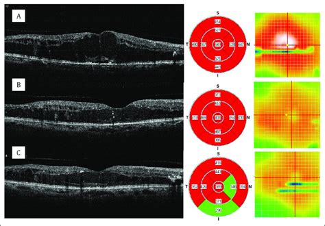 An Optical Coherence Tomography Image From An Eye Showing An Anatomical