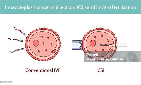 Intracytoplasmic Sperm Injection And In Vitro Fertilization Hand Drawn