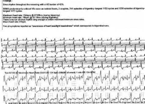 Holter Monitor In Second Pregnancy With Frequent Ventricular Ectopy