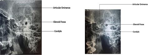 Figure 1 From Reduction Of Manually Irreducible Tmj Dislocation With Forceps Traction Case