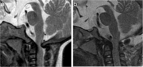 Preoperative T2 Weighted Mri Shows Foramen Magnum Stenosis The