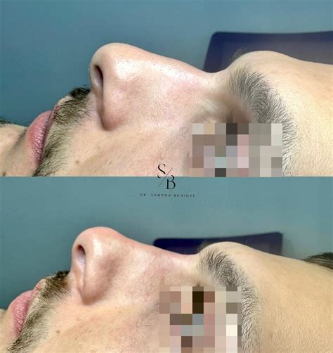 ტუჩის გადიდება ფილერი ბოტოქსი Dr Sandra Benidze • Instagram Photos And Videos