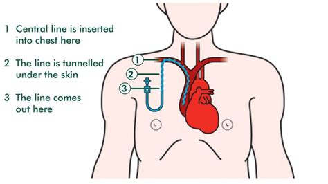 Tunneled Catheter Newest Information Chemotherapy Cancer Oncology